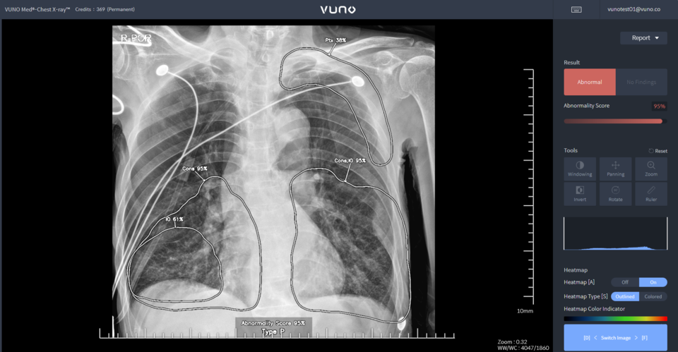 뷰노, 흉부 영상 진단 보조 AI ‘Chest X-ray’ 비급여 청구 시작